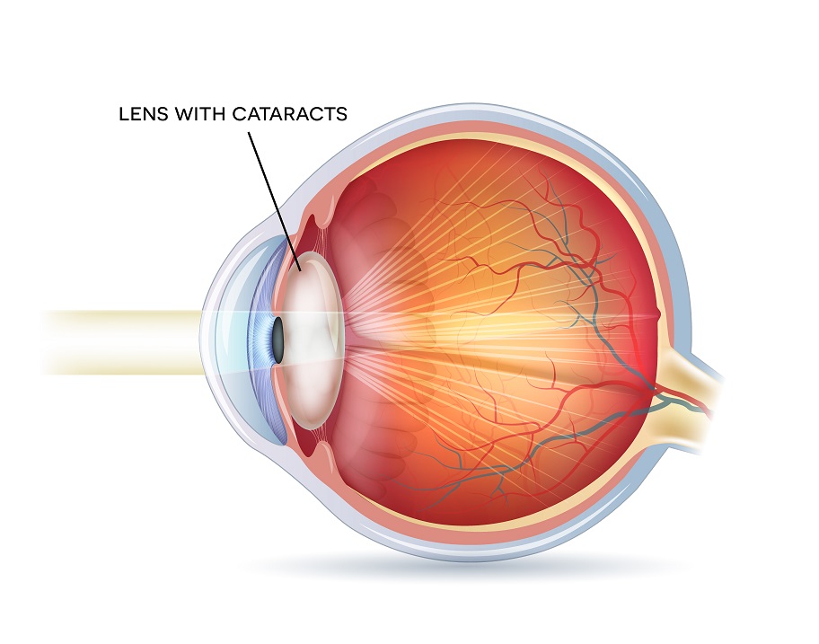 What You Need to Know about Cataracts | Cataract Awareness Month