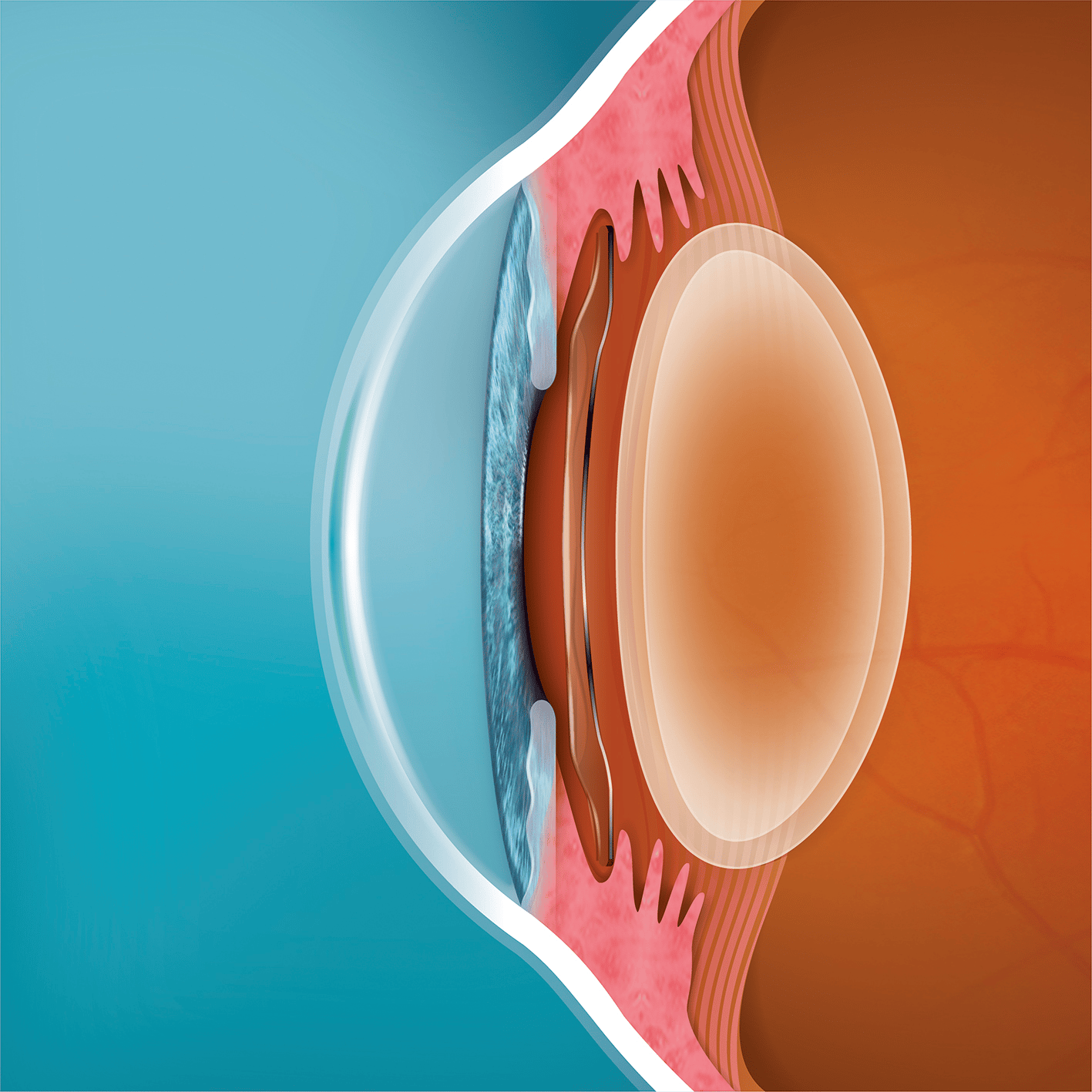 EVO ICL Eye Surgery | EVO Implantable Collamer Lens